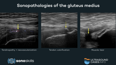 The sense and nonsense of the greater trochanteric pain syndrome